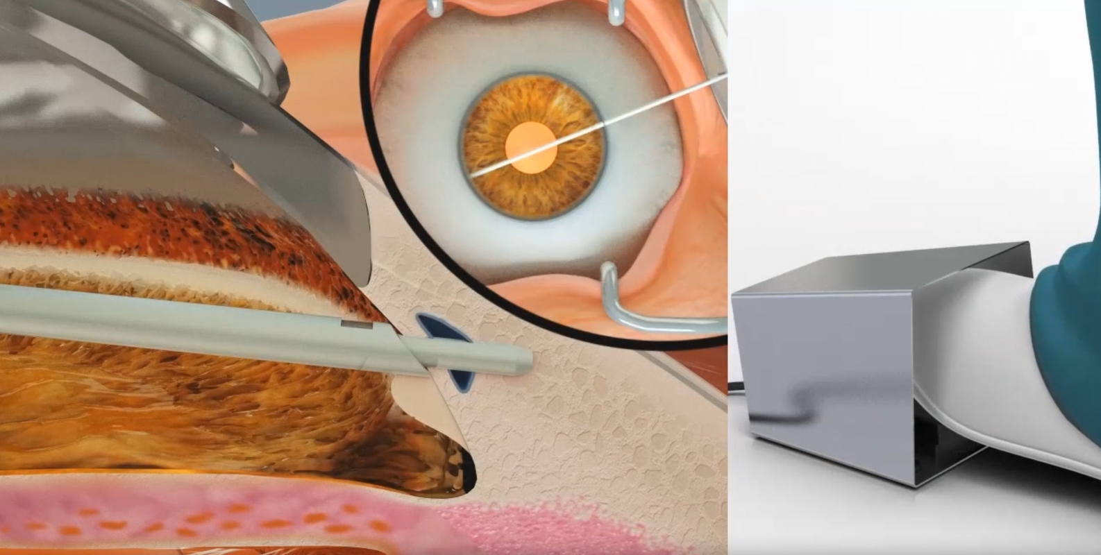 Sanoculis Receives CE Marking for MINT Procedure for Glaucoma | Market Scope